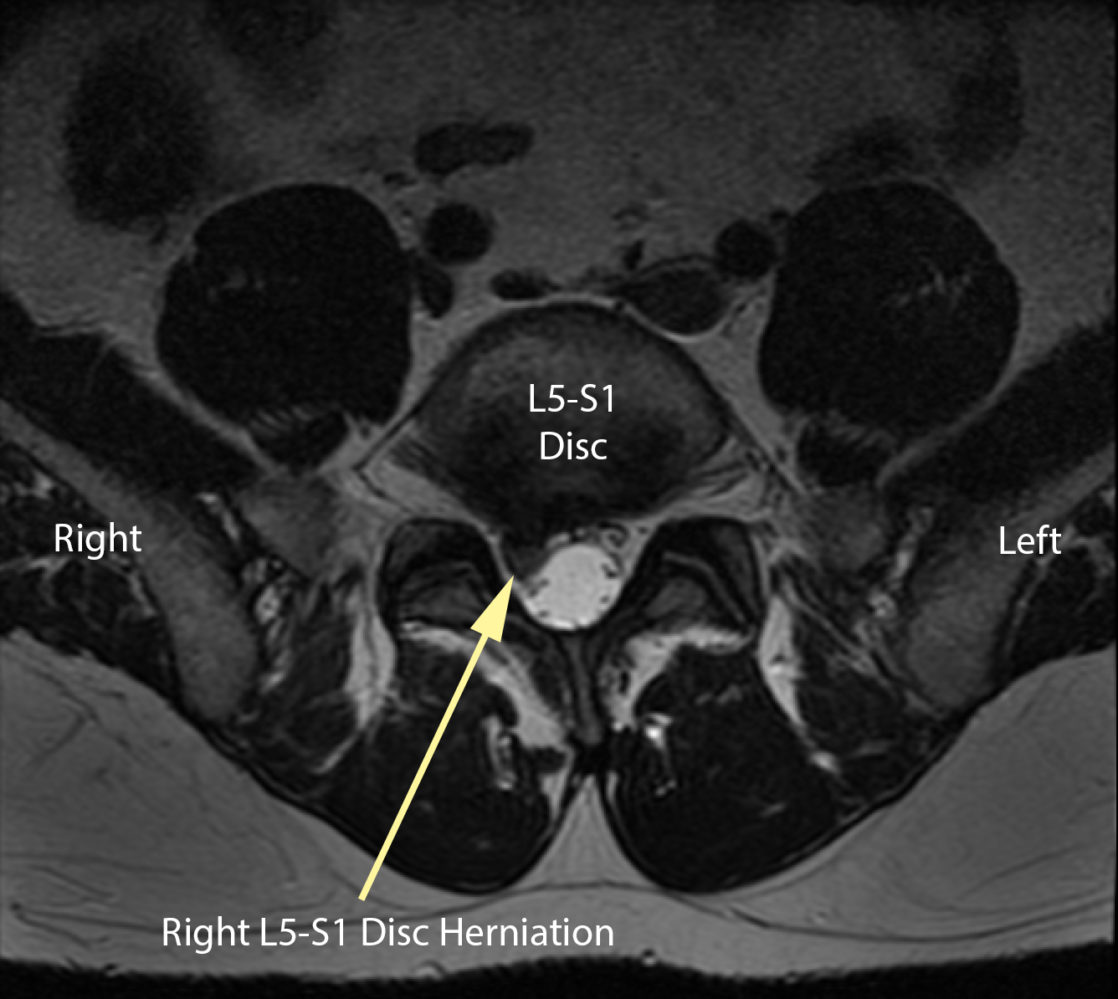 Lumbar Microdiscectomy - Addison Stone